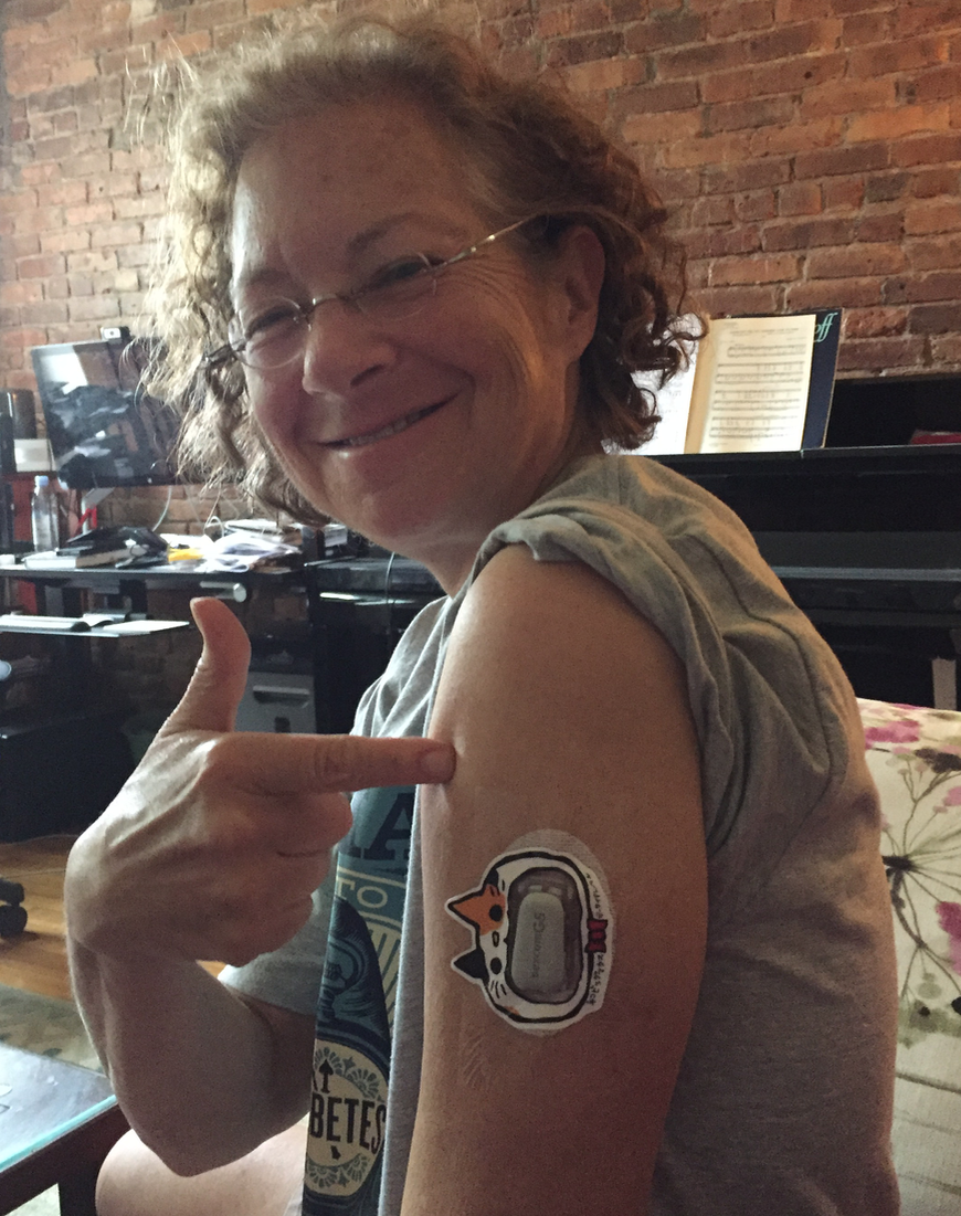 How to wear a Dexcom CGM on your arm | Diabetes Stories